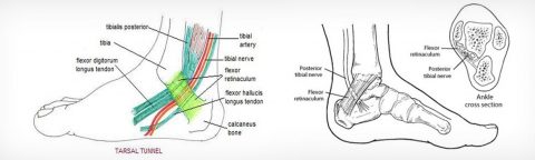 Tarsal Tunnel | Sydney Foot & Ankle Surgeon